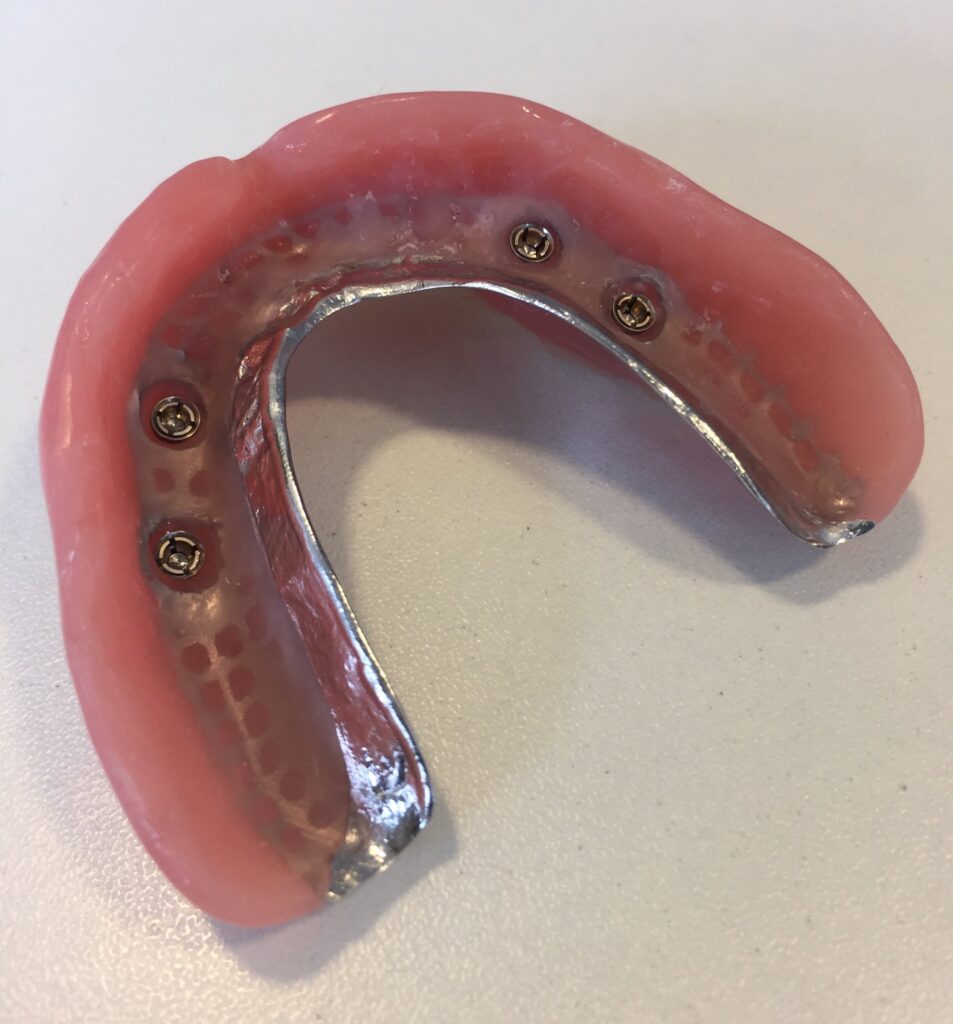 Klikgebit bovenkaak | TPP Femke Grashuis